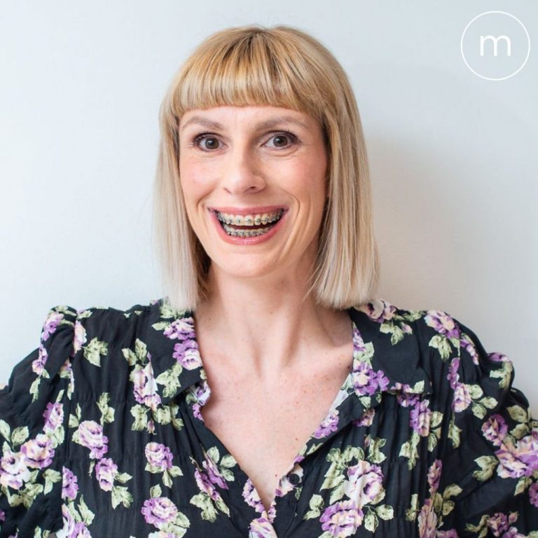 Duboki zagriz i zbijenost gornjih zuba - Case study Maja