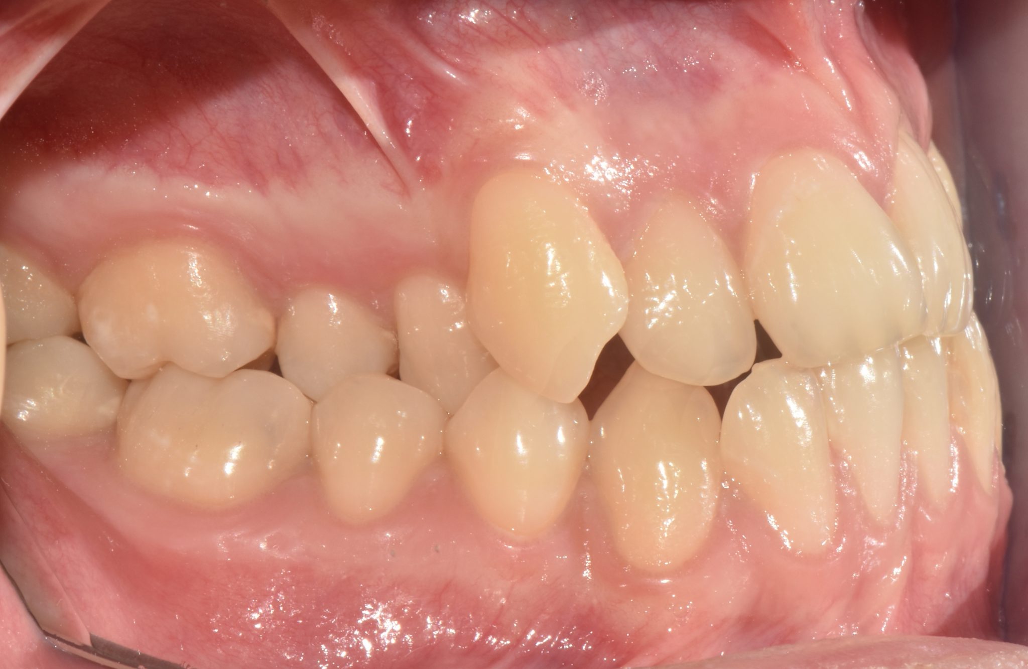 Što je malokluzija? - Ortodoncija Marelić