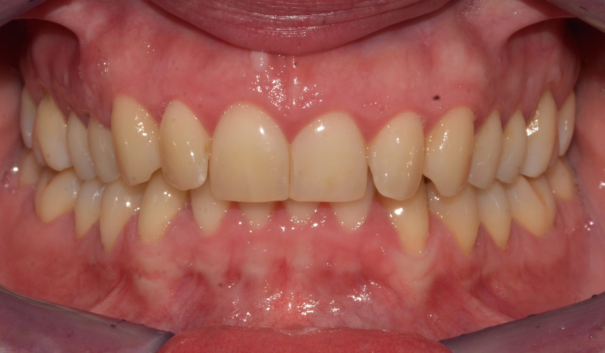 Što je malokluzija? - Ortodoncija Marelić