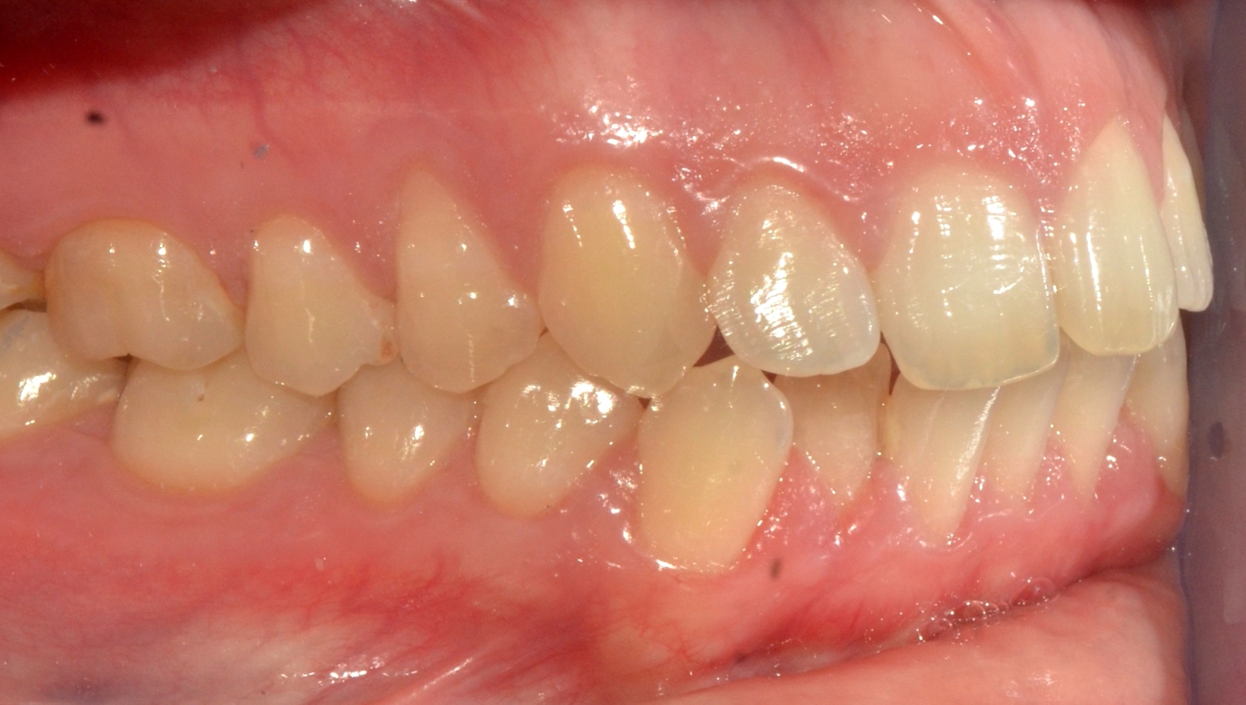 Što je malokluzija? - Ortodoncija Marelić