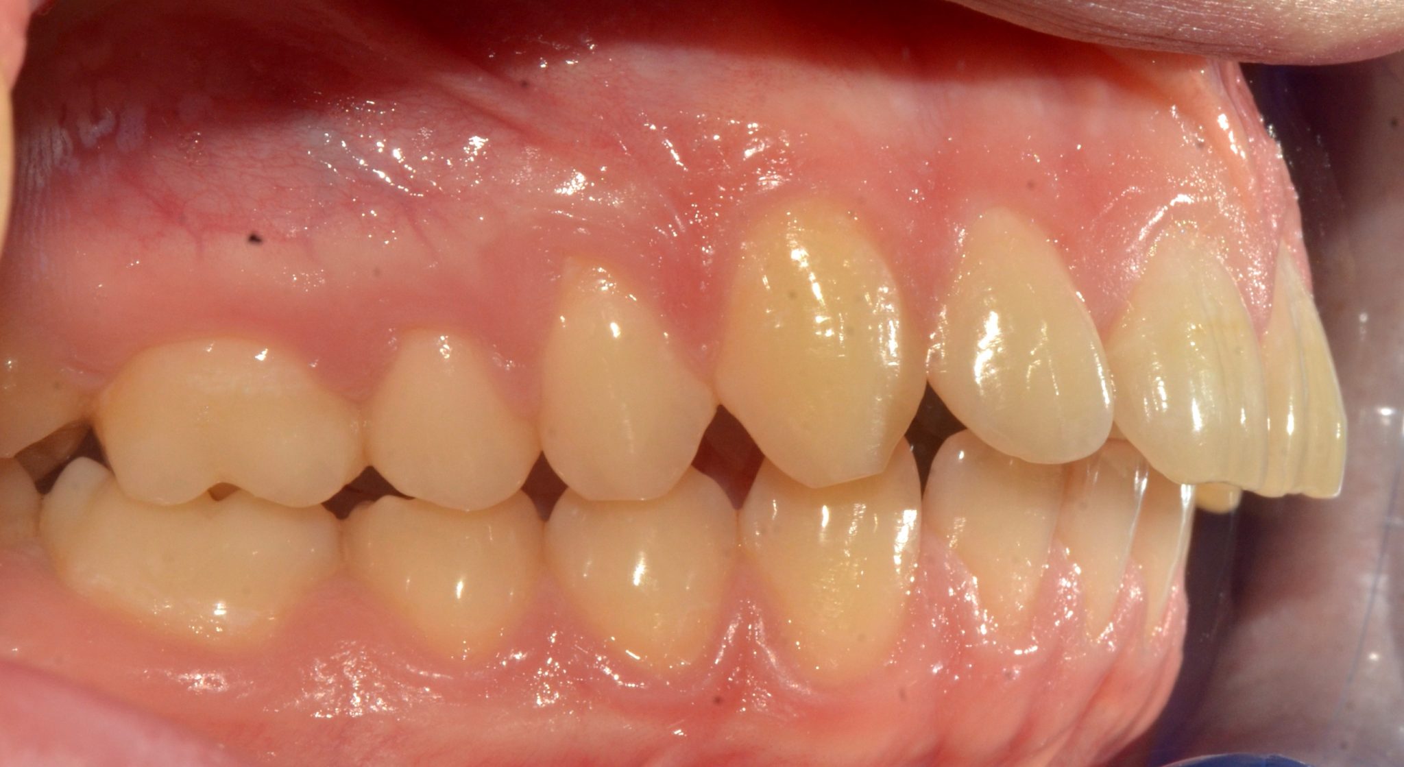 Što je malokluzija? - Ortodoncija Marelić