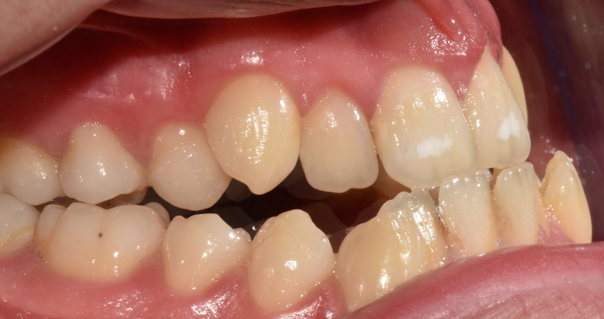 Što je malokluzija? - Ortodoncija Marelić