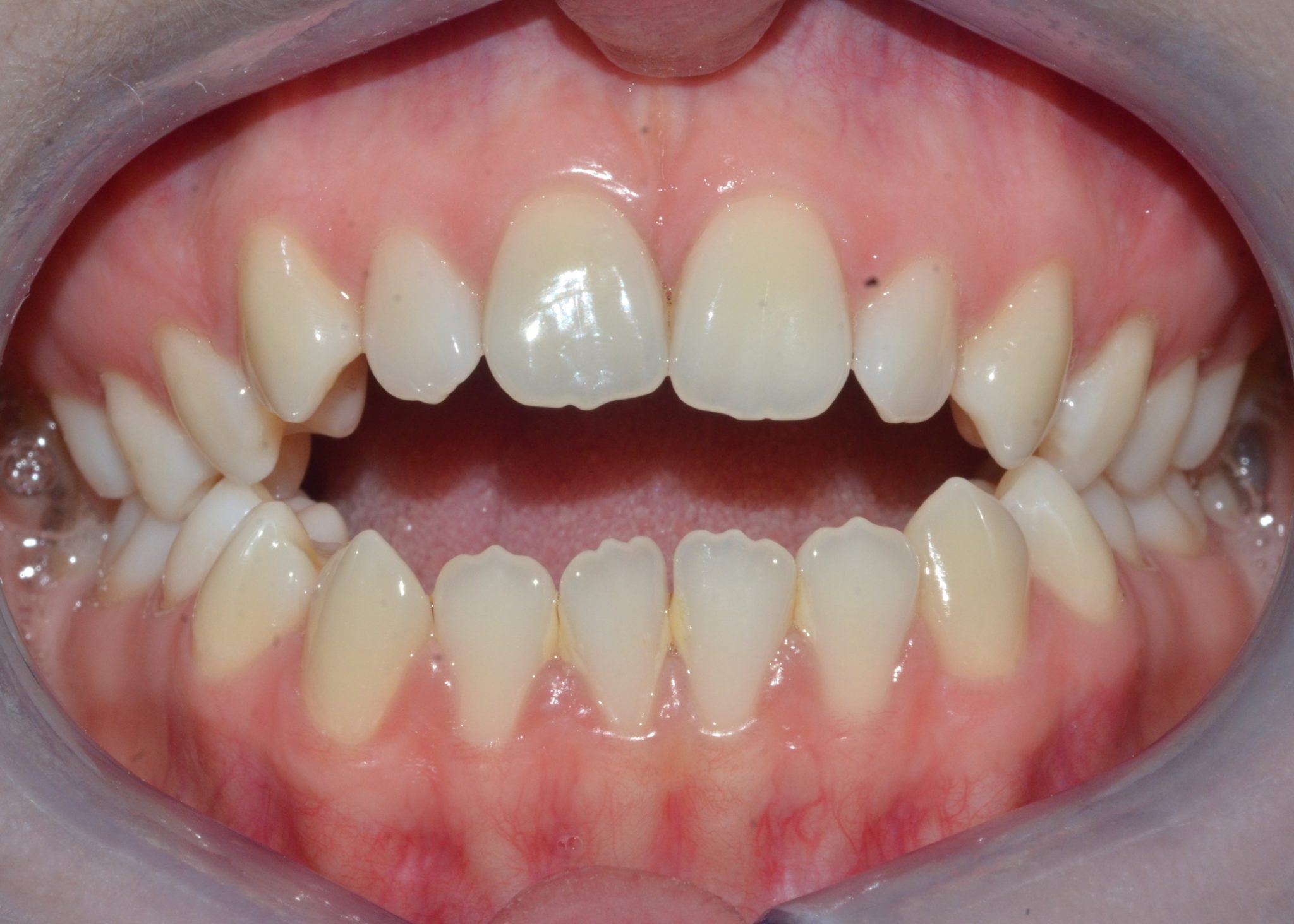 Što je malokluzija? - Ortodoncija Marelić